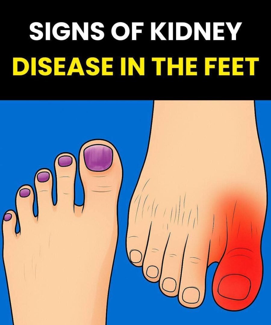 Signs of Kidney Disease That Show Up in the Feet…….. – Home