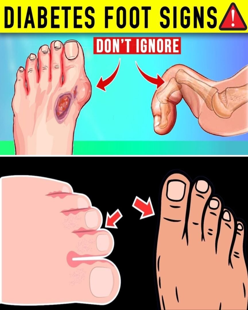 Diabetes Foot Signs – Don’t Ignore Them…… – Home